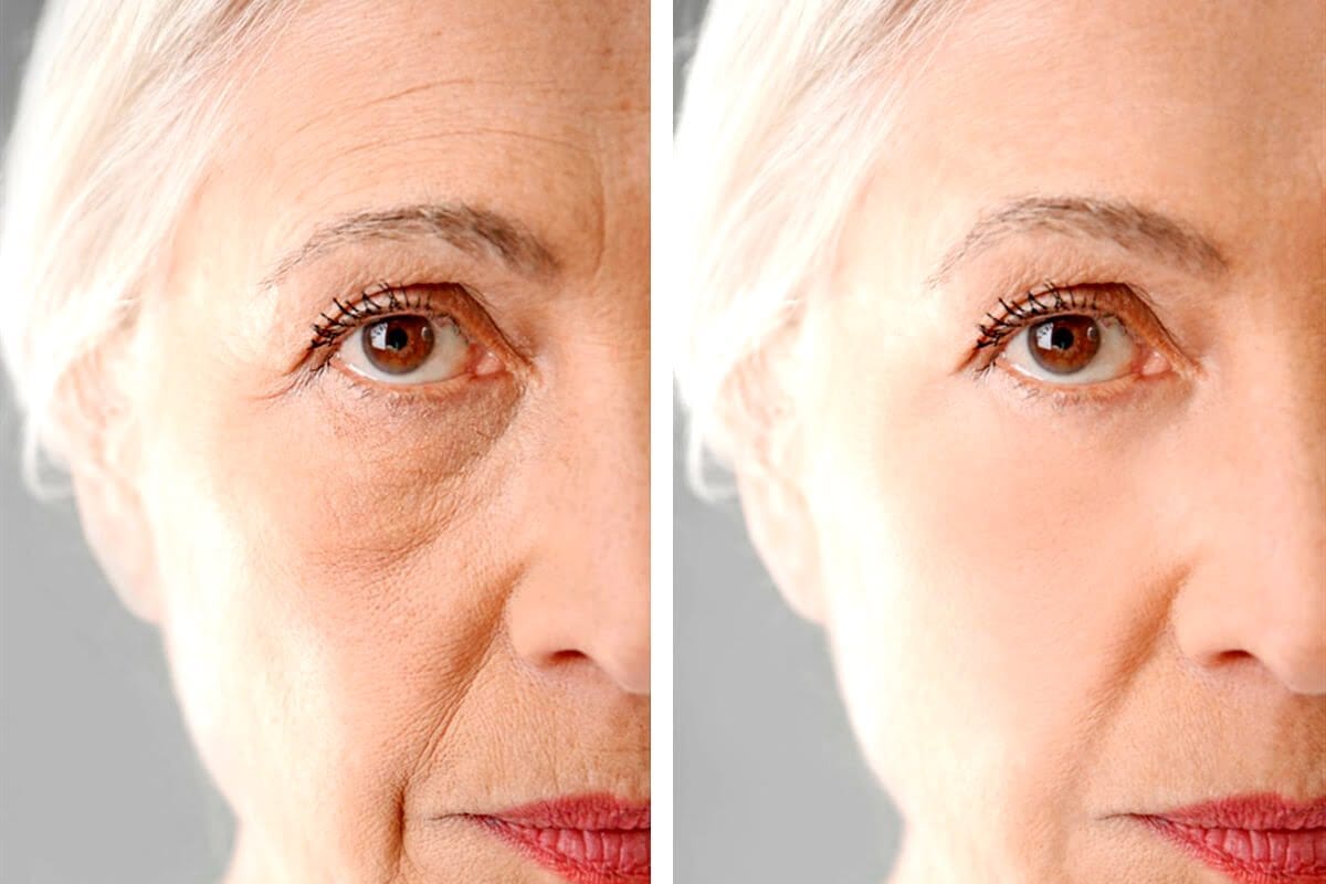 Mini face lifting samo jednim tretmanom – Ultrazvučni SMAS lifting lica ...